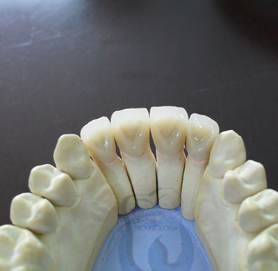 Products / Fixed Restoration / Full Ceramics_Creation Dental Technology