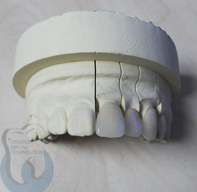 Products / Fixed Restoration / Full Ceramics_Creation Dental Technology