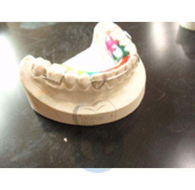 Products / Orthodontics and Retainer / Orthodontic_Creation Dental ...